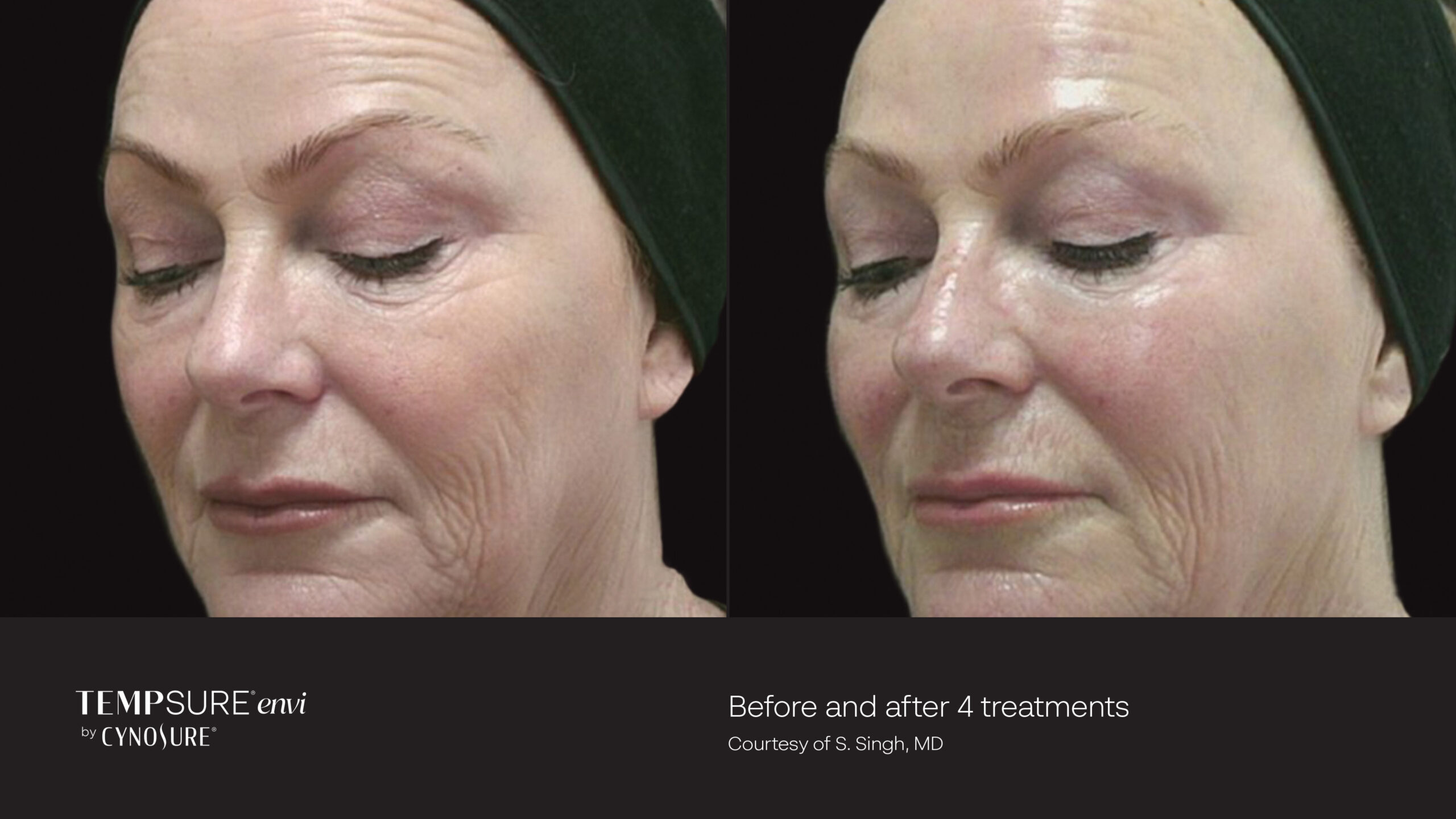 TempSure Envi | Skin Tightening - Dr Bruce Robinson