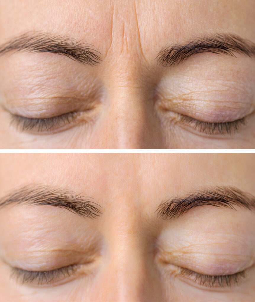 Injectables Help You Look Younger With Natural, Reliable Results