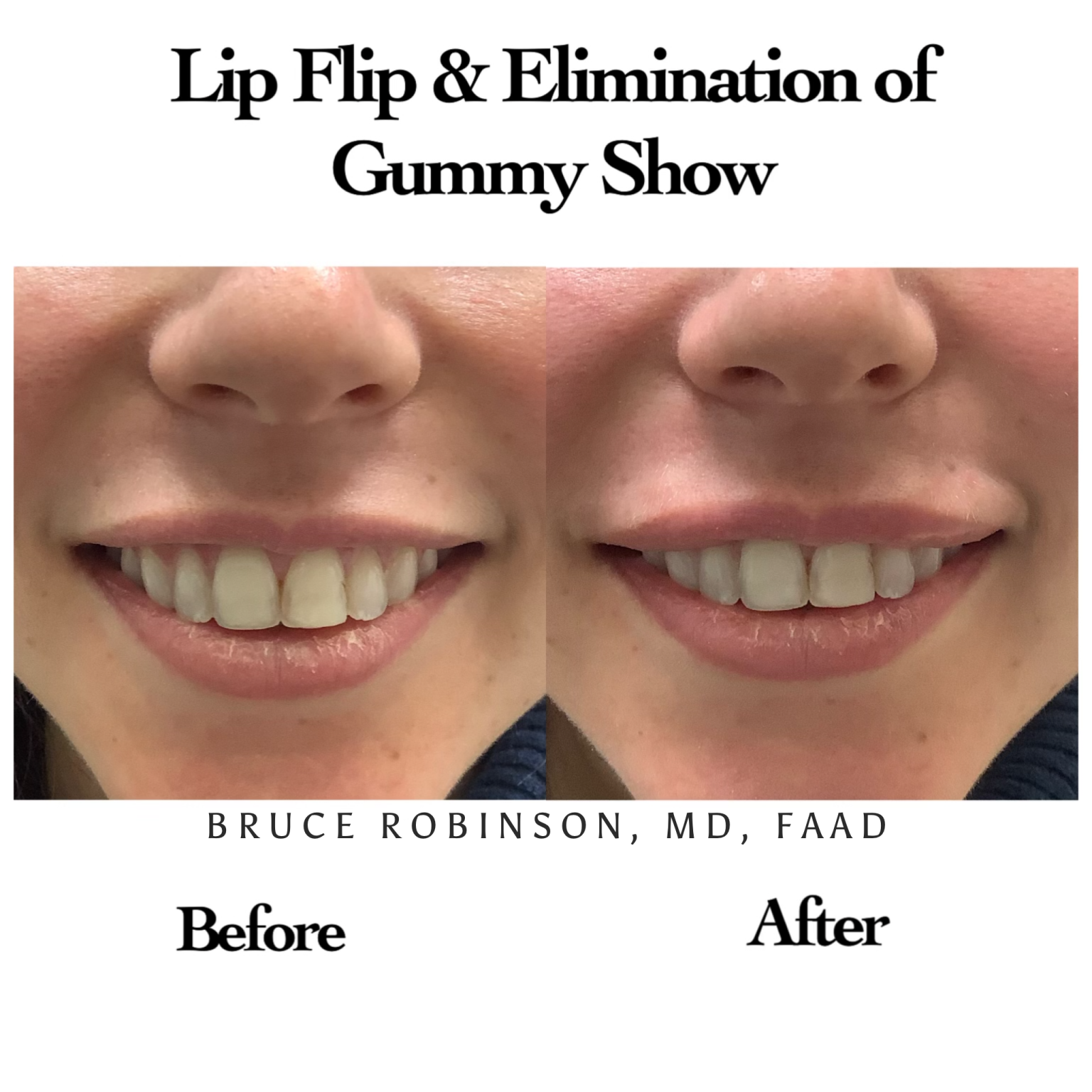 LIP FLIP vs LIP FILLER - Dr Bruce Robinson